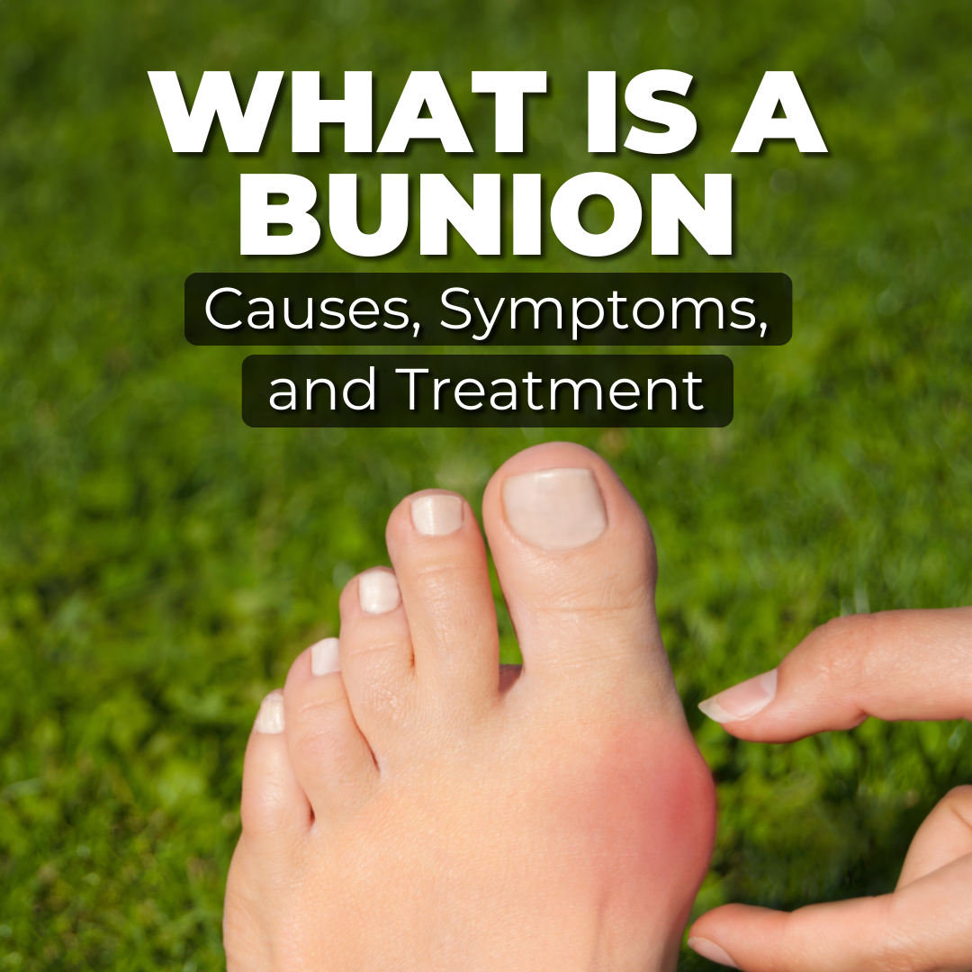What is a Bunion - Causes, Symptoms, and Treatment – Hike Footwear